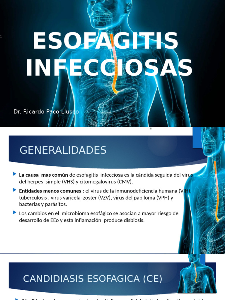 Esofagitis Infecciosa UNITEPC.1 | PDF | Candidiasis | Medicina