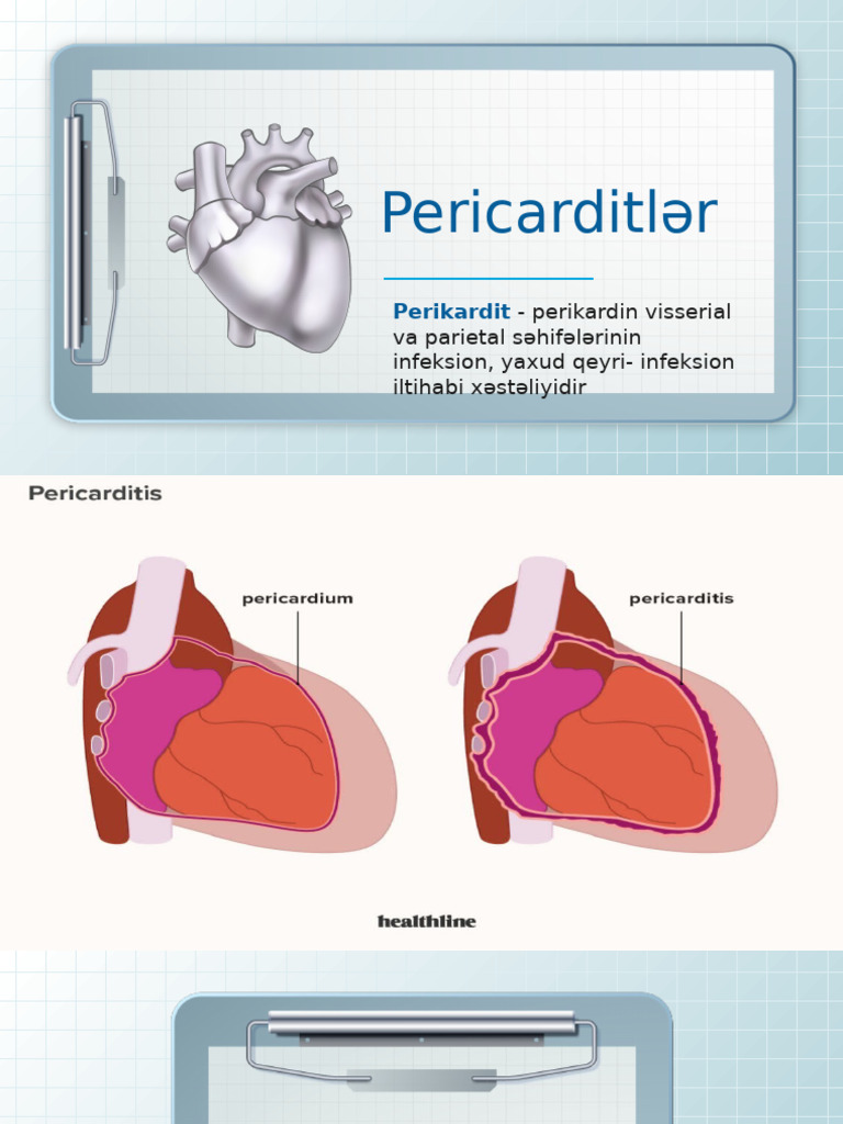 Perikardit Kopyası | PDF