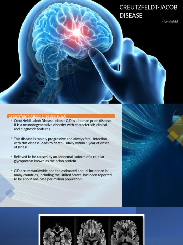 Creutzfeldt-Jacob Syndrome (By Shahid) | PDF | Diseases And Disorders ...