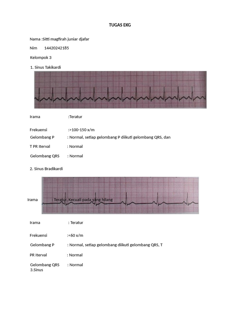 Osce Ekg - Siti Maghfirah Juniar n Djafar | PDF