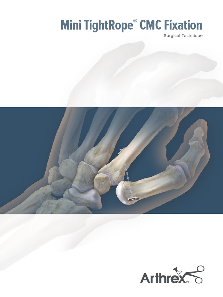 Mini Tightrope CMC Fixation | PDF | Thumb | Musculoskeletal System