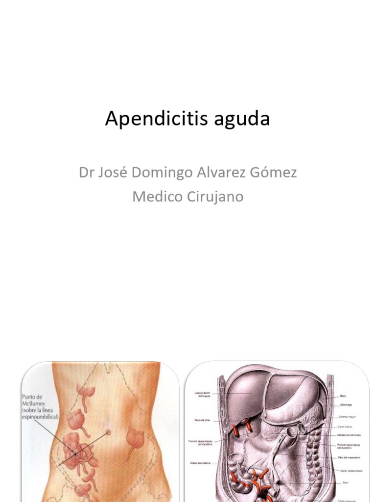 Semio Qx I - 8 - Apendicitis Aguda - José | PDF | Enfermedades y trastornos | Medicina CLINICA