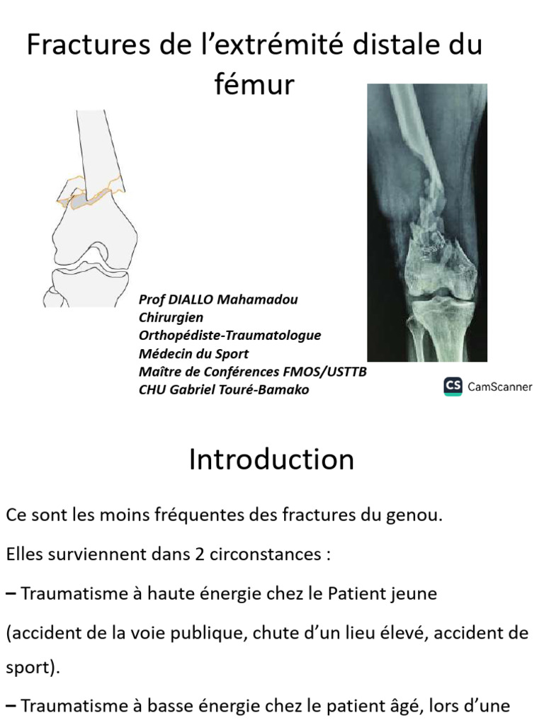 Fractures de L'extrémité Distale Du Fémur | PDF | Genou | Appareil ...