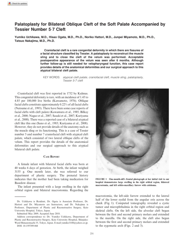 Palatoplasty for Tessier Clefts | PDF | Primate Anatomy | Surgical ...