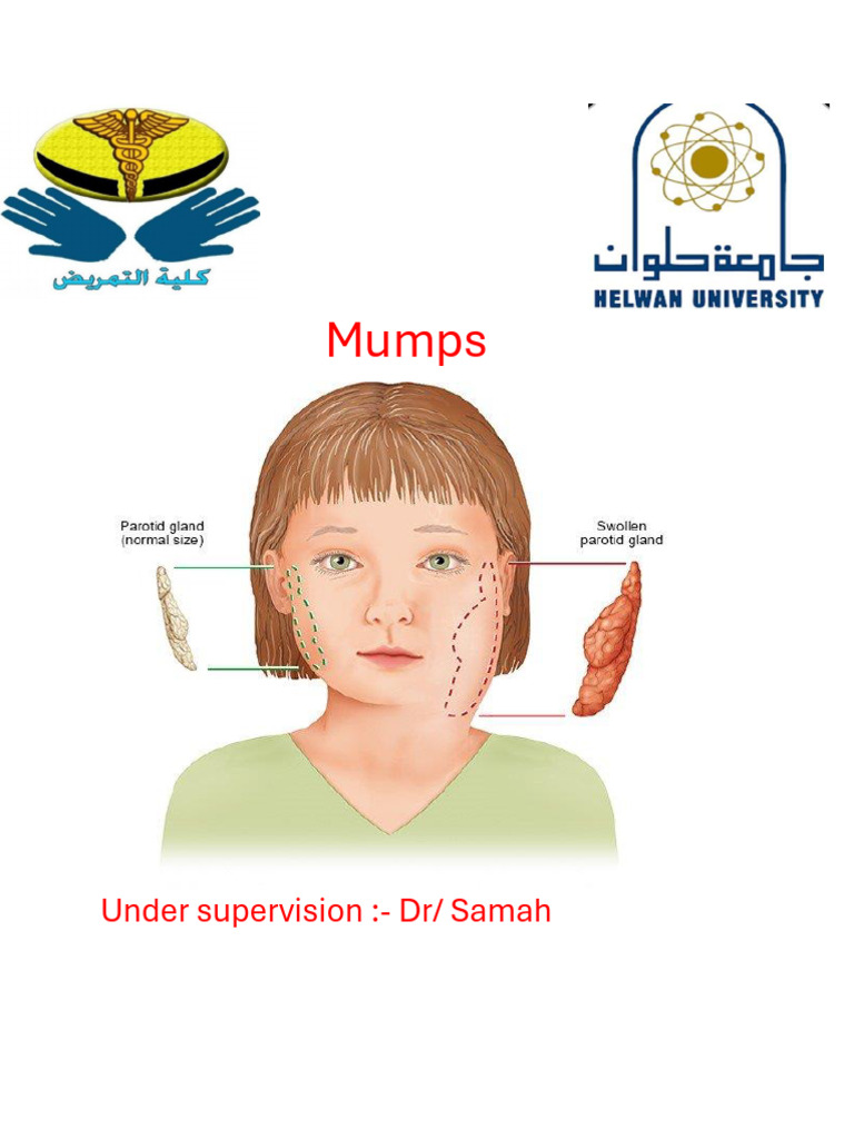 Mumps: Symptoms, Diagnosis, and Management | PDF | Clinical Medicine ...
