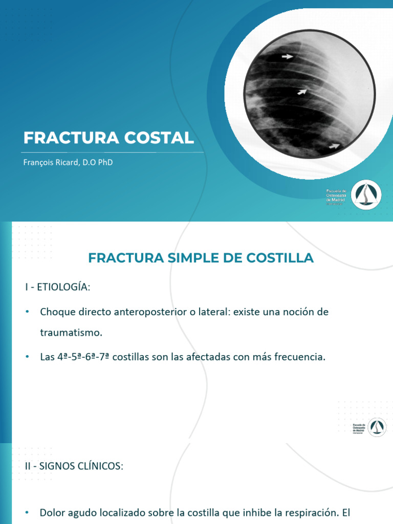 4 4 Fractura Costal | PDF