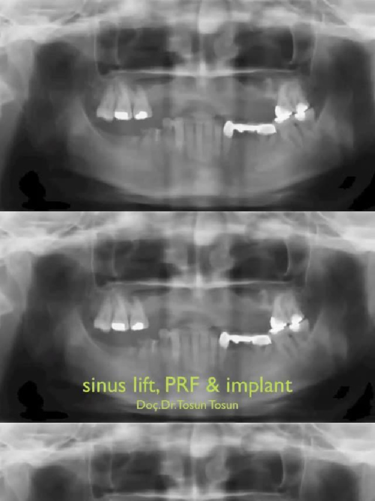 Sinus lift surgery life | PDF