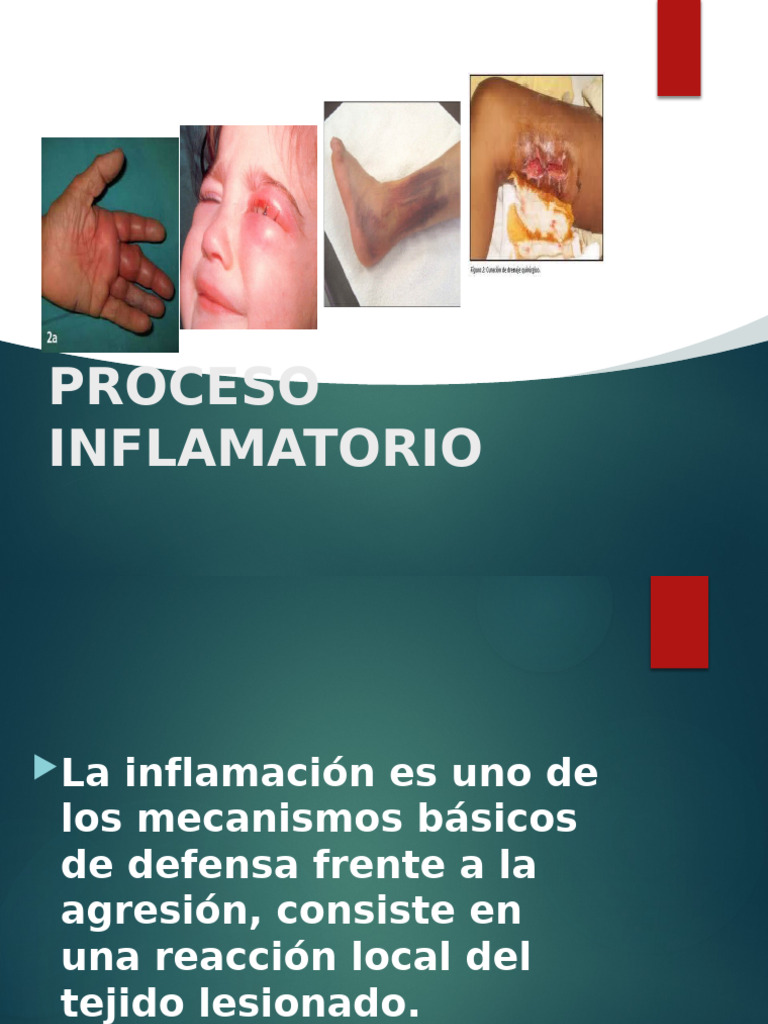 1 Proceso inflamatorio-1 | PDF | Inflamación | Inmunología