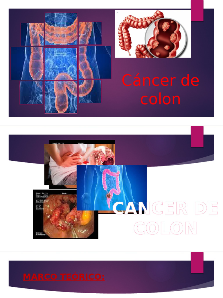 Cáncer de Colon: Causas, Síntomas y Tratamiento | PDF