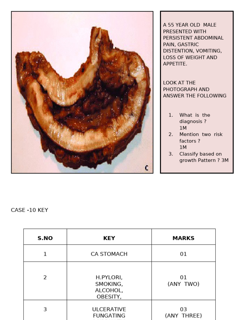 Stomach Cancer Case Study Analysis | PDF