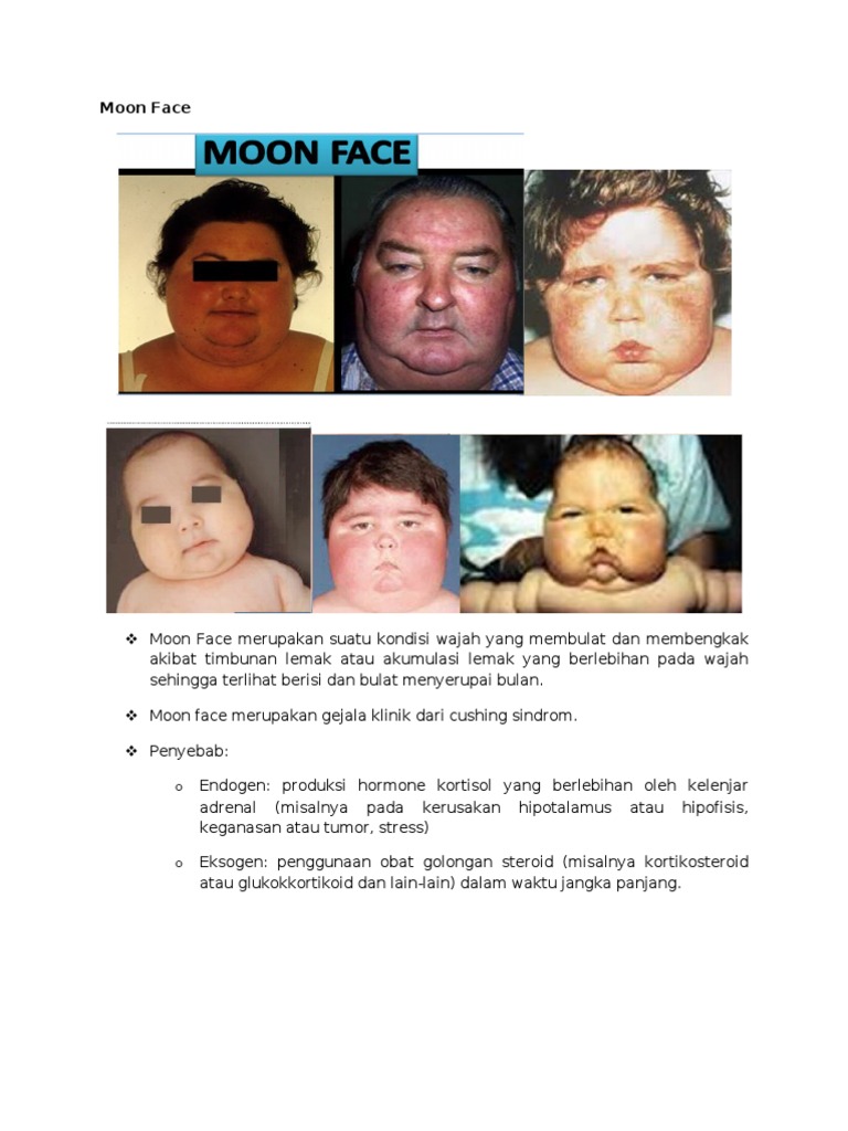 Penyebab dan Ciri Moon Face | PDF