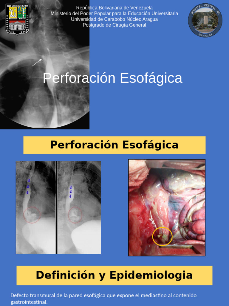 Perforacion Esofagica | PDF | Tórax | Medicina