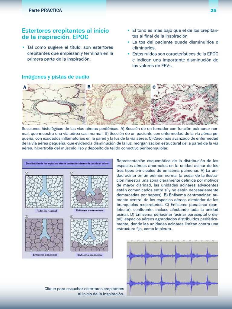 Estertores Crepitantes Al Inicio de La Inspiracion. EPOC | PDF ...