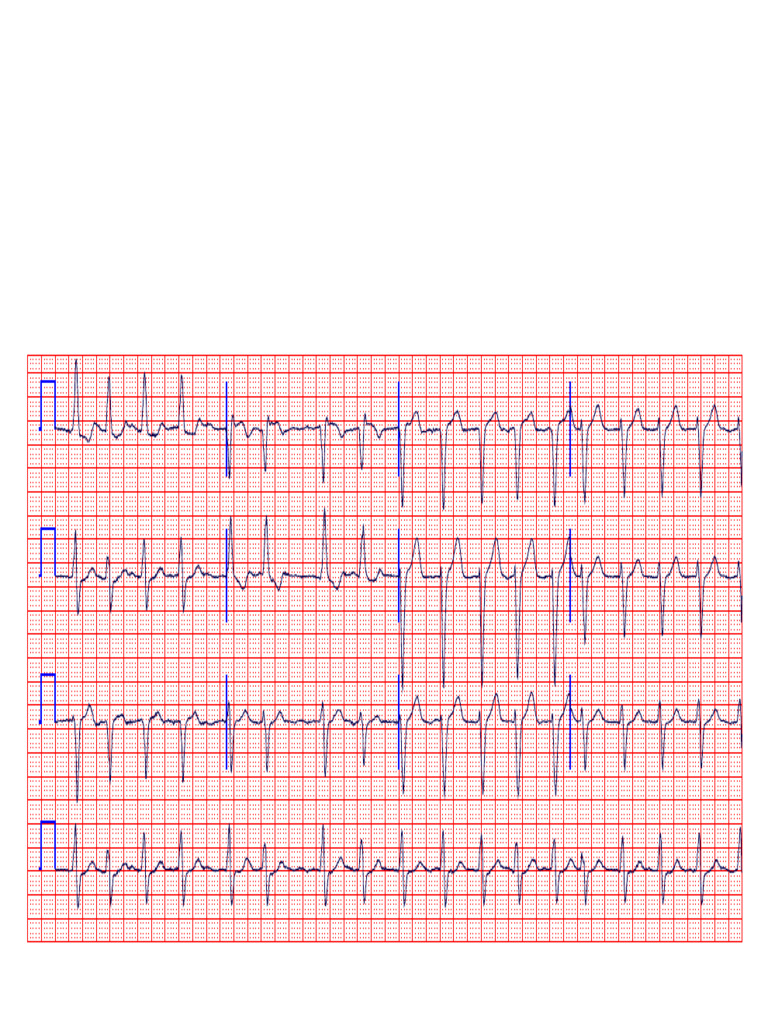 I aVR V1 V4: Case #446 | PDF
