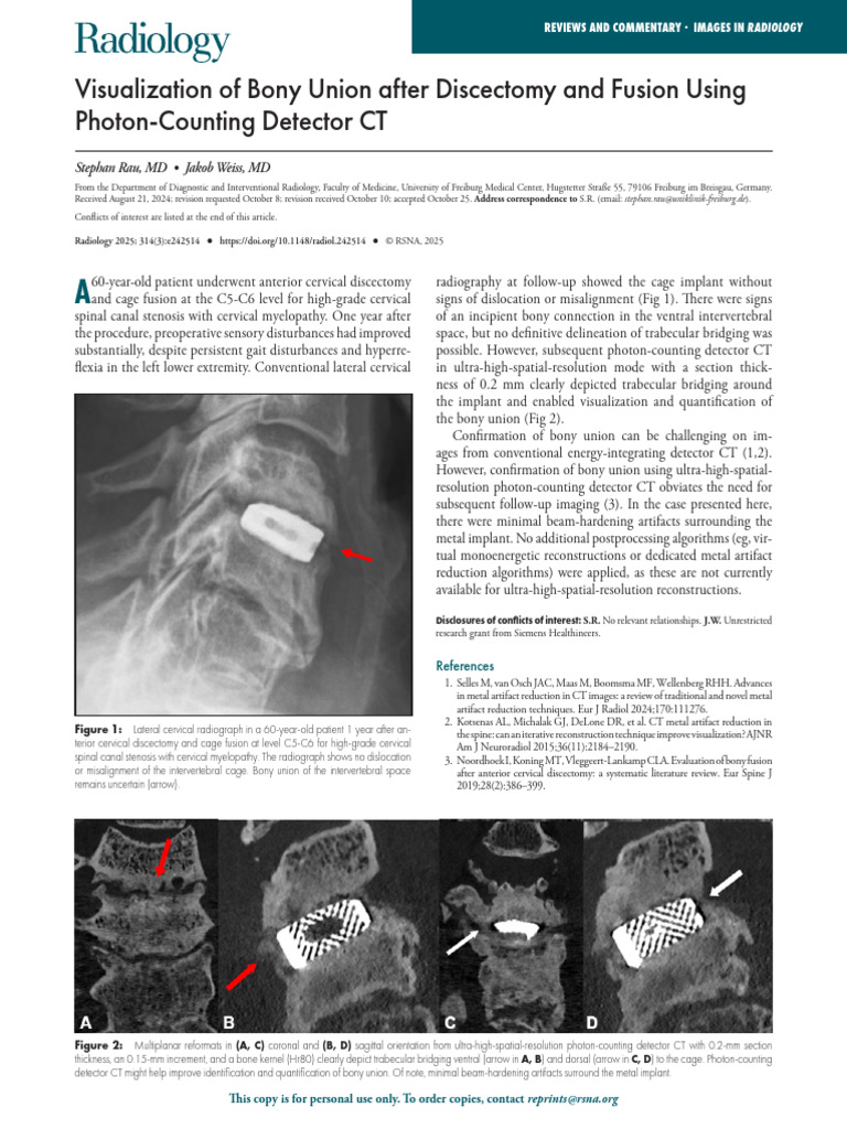 Visualization of Bony Union After Discectomy and Fusion Using Photon Counting Detector CT | PDF ...
