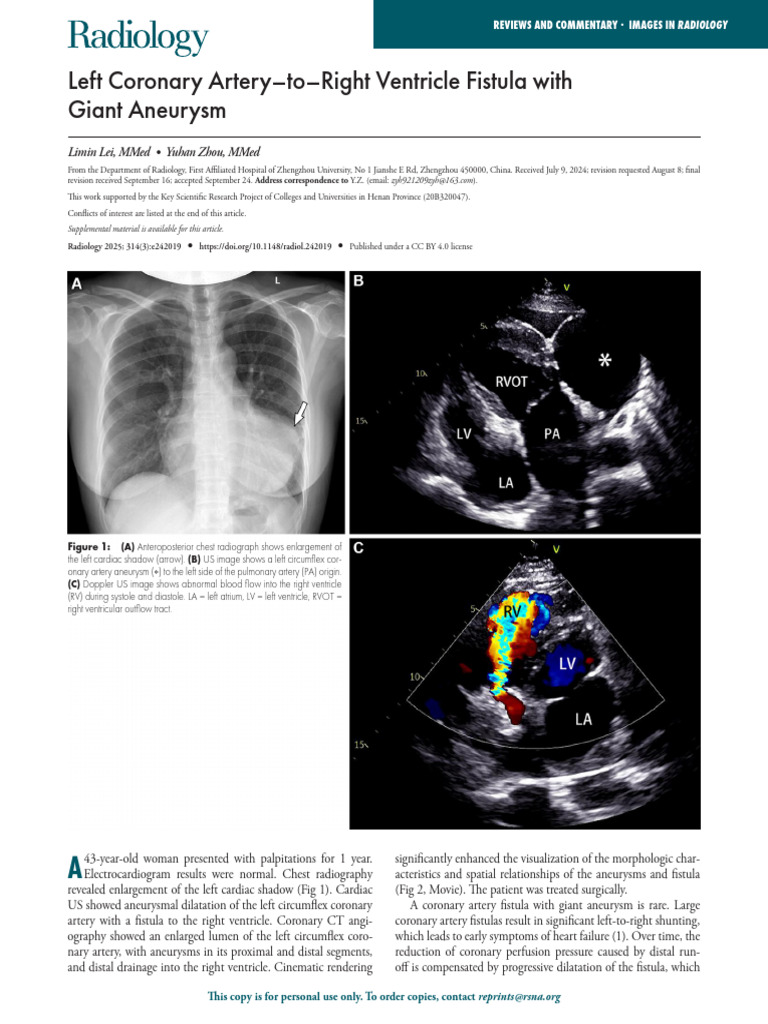 Left Coronary Artery To Right Ventricle Fistula With Giant Aneurysm ...