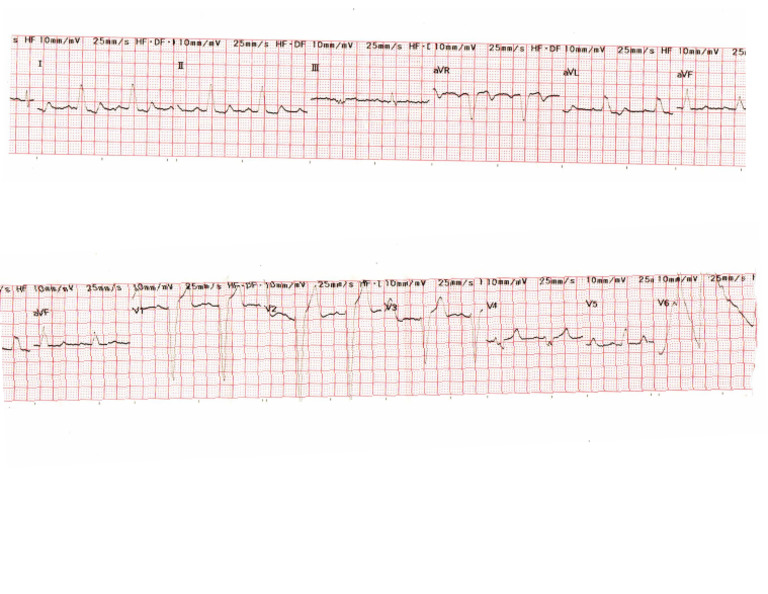 ECG | PDF
