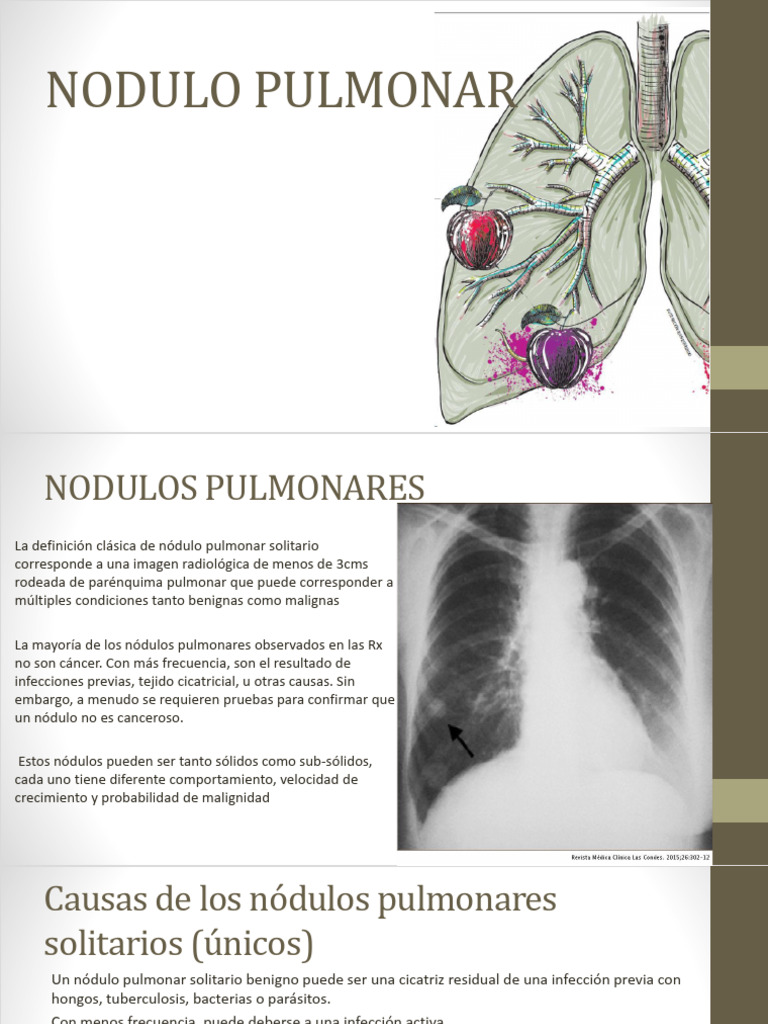 Nodulo Pulmonar | PDF