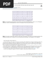Sgarbossa Criteria - LITFL - ECG Library Diagnosis | PDF ...