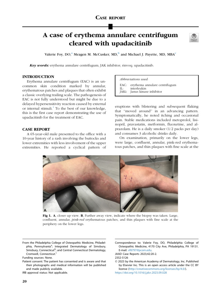 Erythema Annulare Centrifugum Treated with Upadacitinib | PDF ...