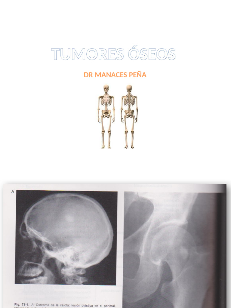 Tumores Óseos | PDF
