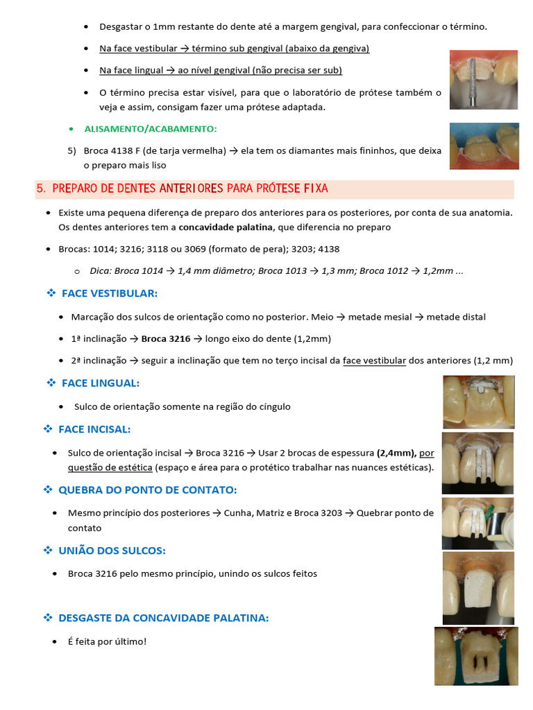 Preparo Dente Anterior - Protese | PDF