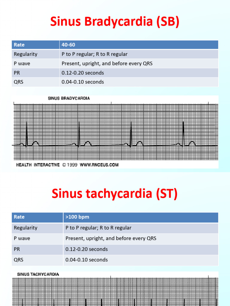 Overview of Basic Arrhythmias | PDF | Cardiology | Cardiac ...