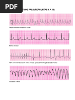 Ritmos Cardíacos ACLS | PDF