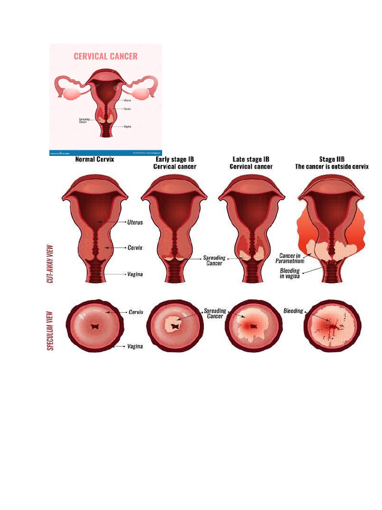 Cervical Cancer | PDF