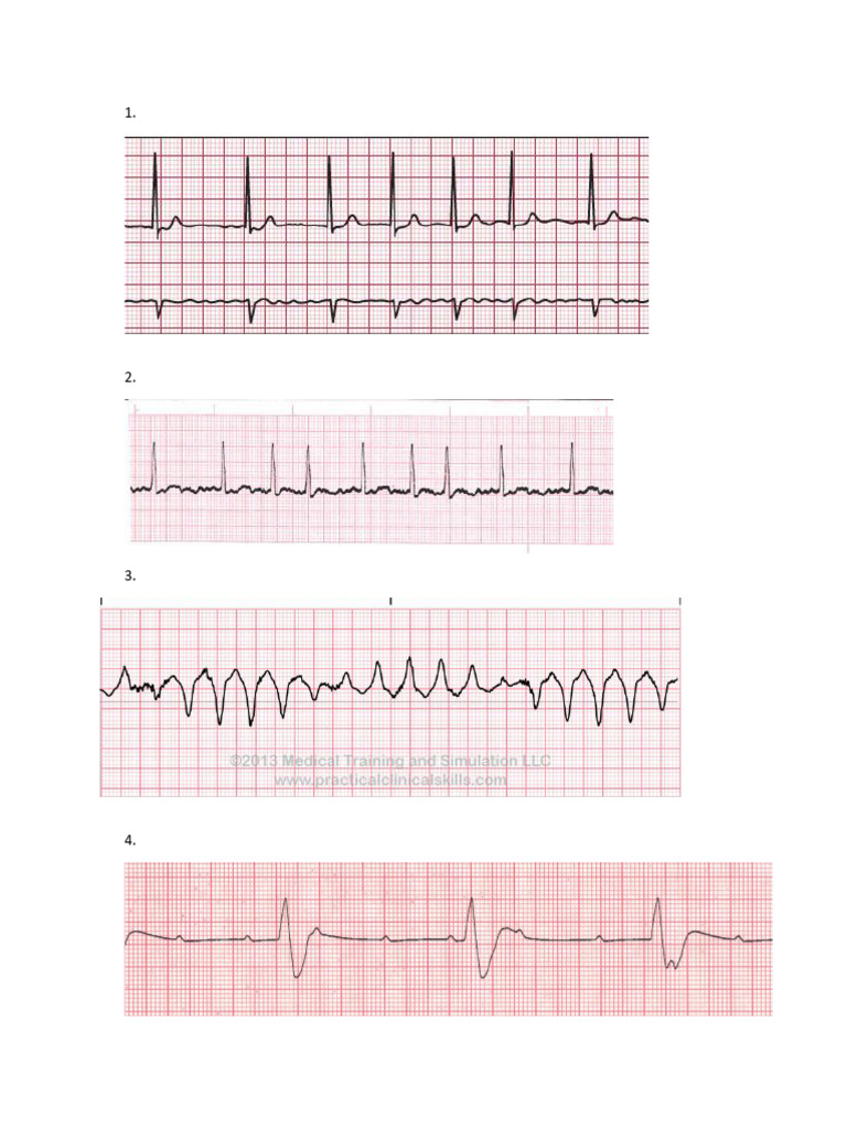 ECG+Strips+for+Interpretation-1 | PDF
