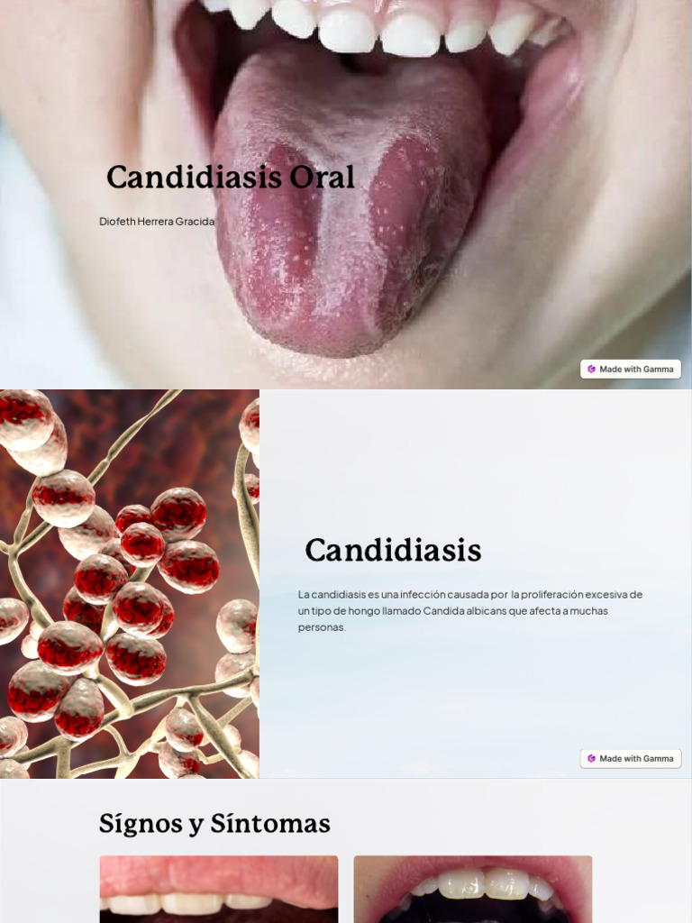 Candidiasis Oral | PDF | Candidiasis | Enfermedades y trastornos