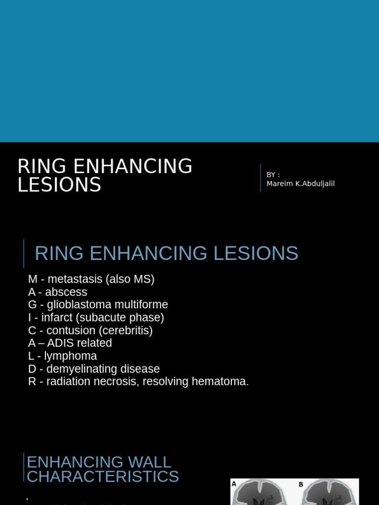 Ring Enhancing Lesions f | PDF | Metastasis | Neoplasms