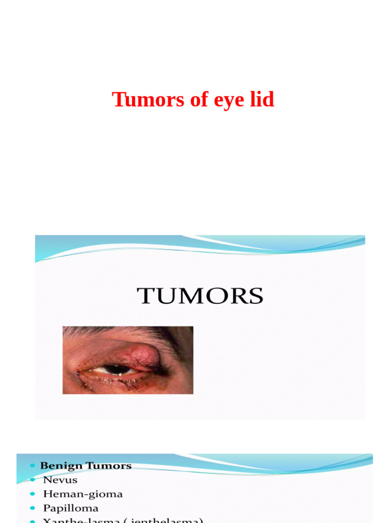 tumors of eye lid | PDF