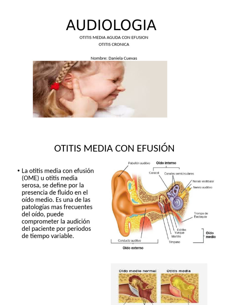 Otitis Media Con Efusion y Cronica | PDF | Oído | Escuchando