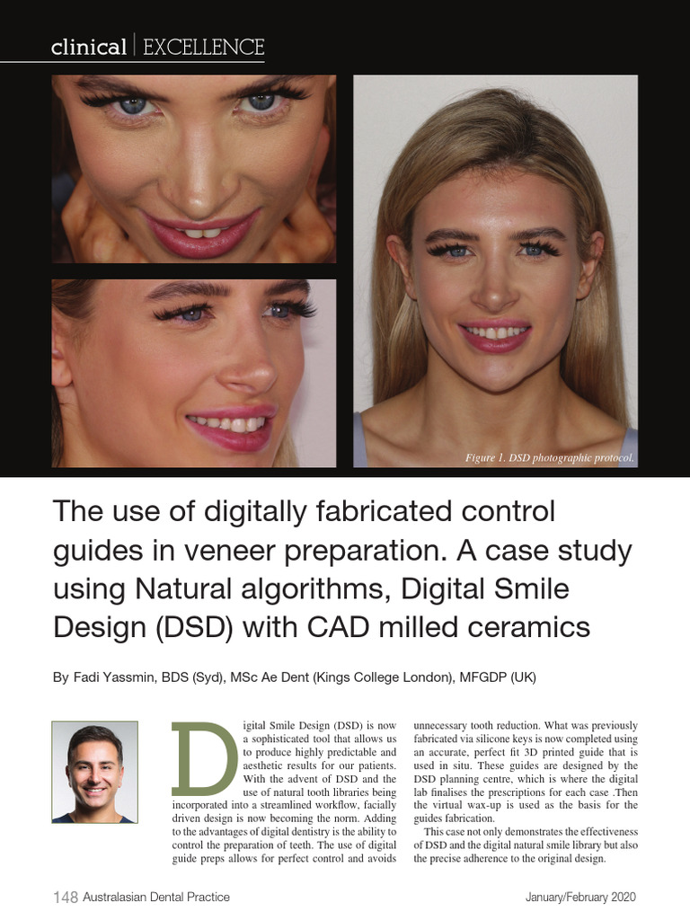 The Use of Digitally Fabricated Control Guides in Veneer Preparation A ...
