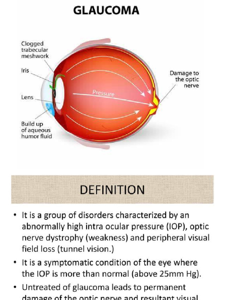 glucoma | PDF