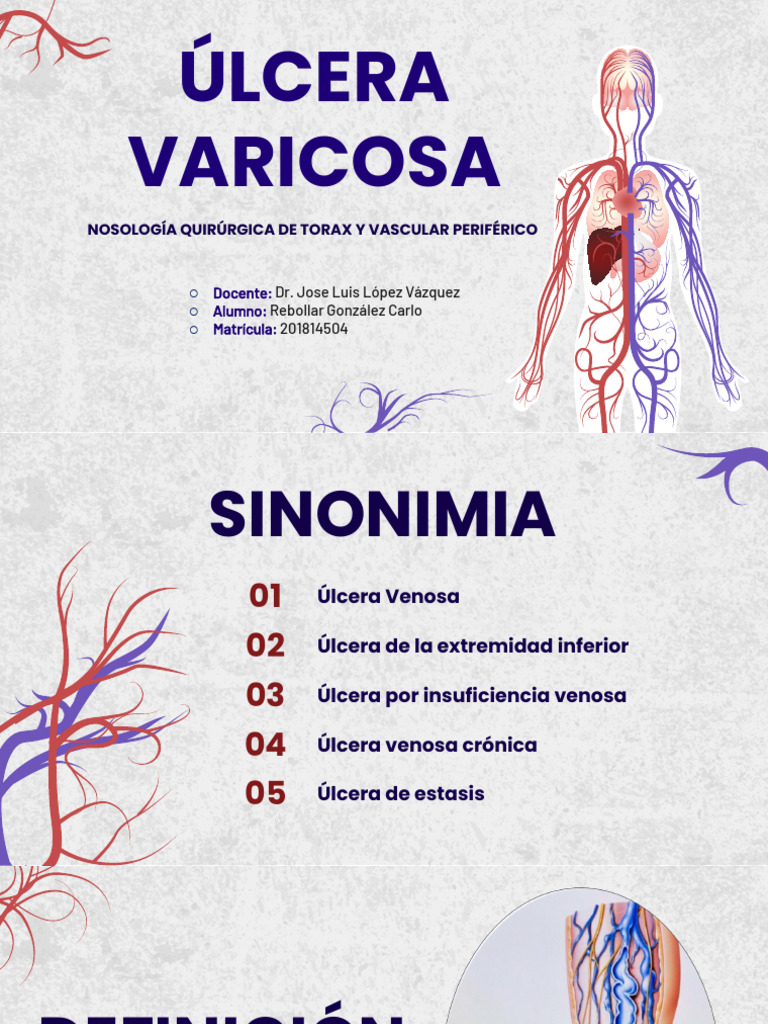 Úlcera Varicosa | PDF | Especialidades Medicas | Enfermedades y trastornos