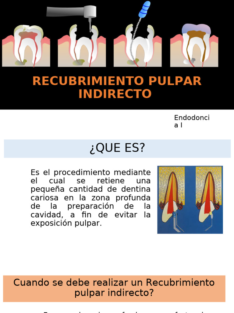 Recubrimiento Pulpar Indirecto | PDF | Especialidades Medicas | Medicina CLINICA