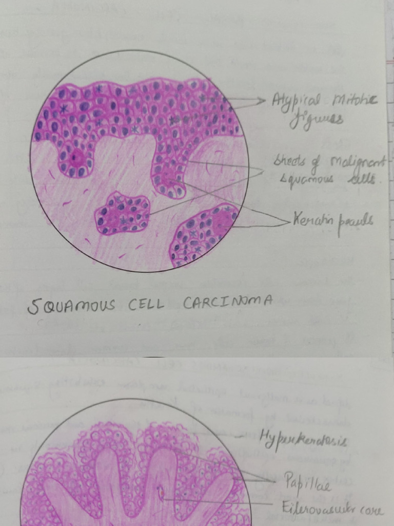 Squamous cell carcinoma and Squamous cell papilloma | PDF