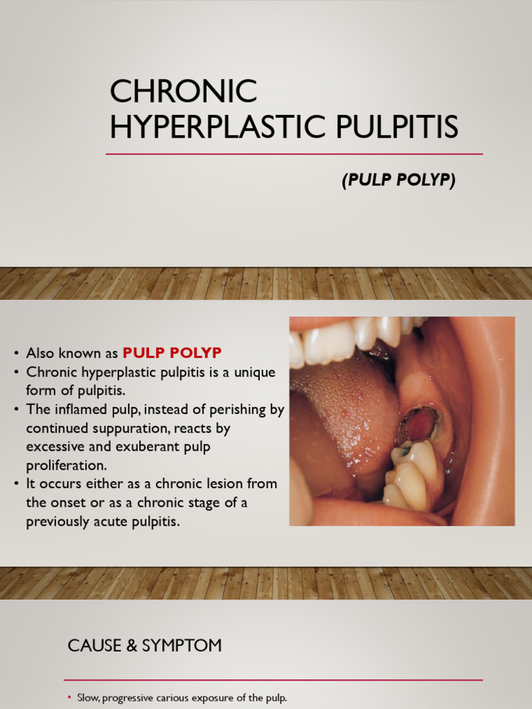 Chronic Hyperplastic Pulpitis-1 | PDF | Inflammation | Anatomy