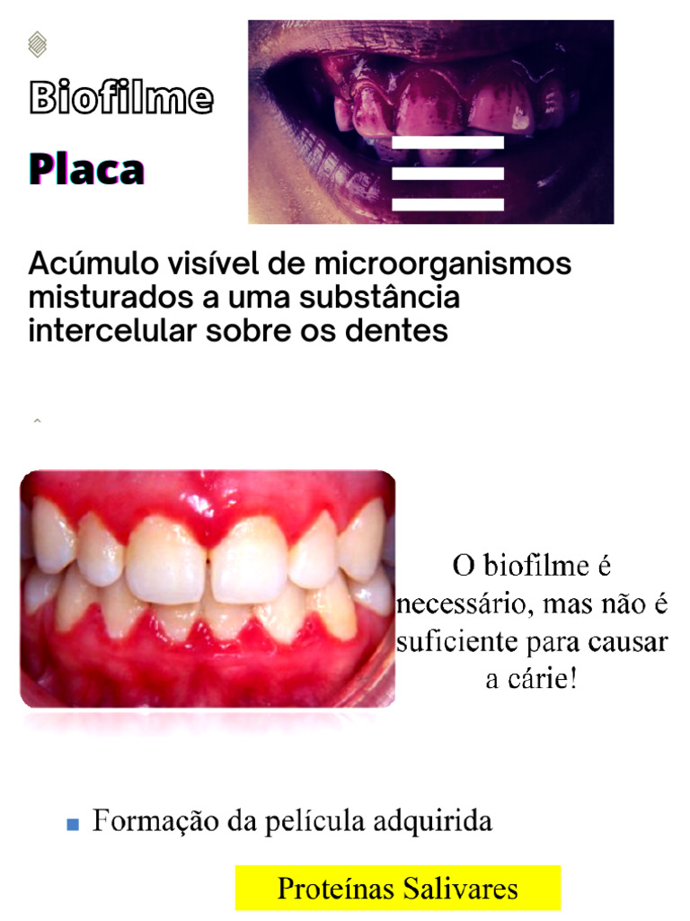 Patogênese Das Lesões Cariosas.pdf | PDF