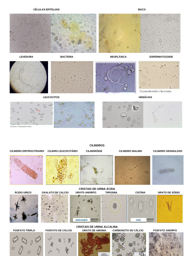 Atlas Urinálise Modificado-1 | PDF