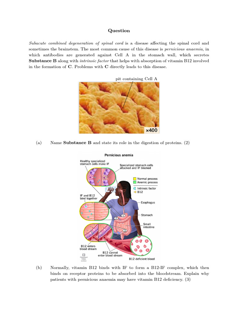 Subacute Combined Degeneration Overview | PDF | Nerve | Brainstem