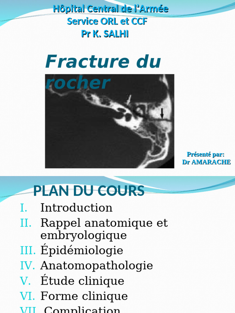 Fracture Du Rocher DR Amarache 2016 | PDF | vertige | Traumatisme crânien