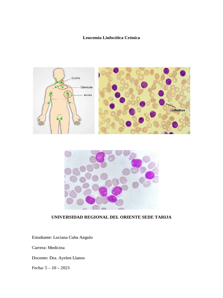 Leucemia linfocítica crónica TRABAJO 1 | PDF | Cáncer | Leucemia