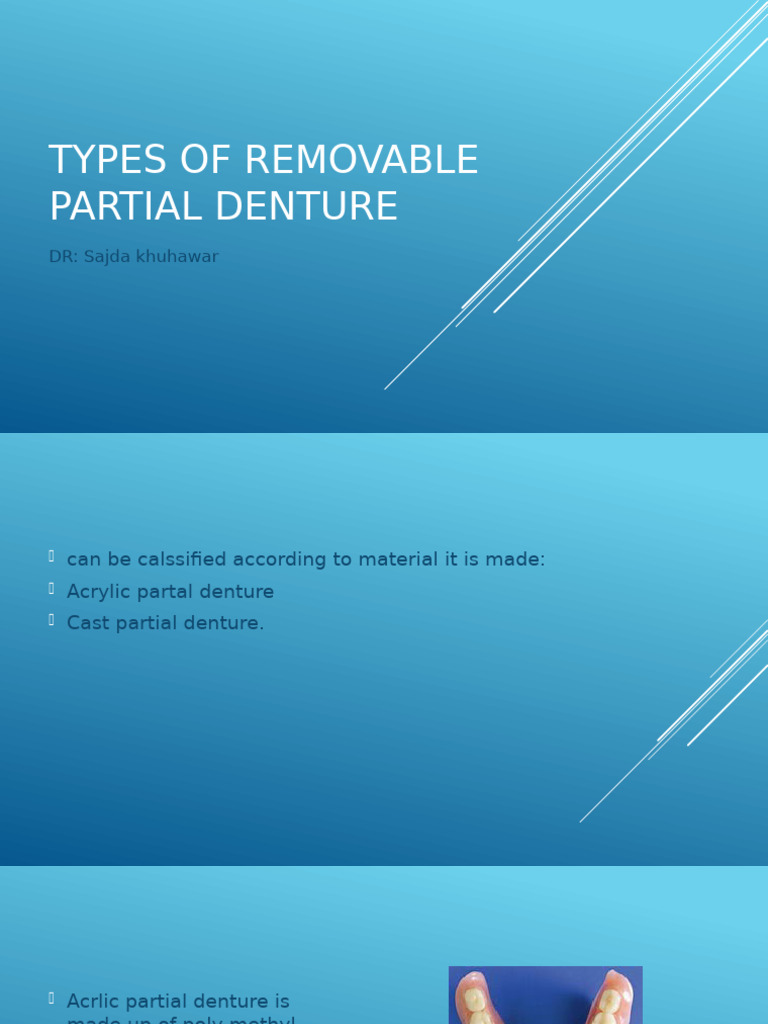 Types of Removable Partial Denture | PDF | Dentures | Dentistry Branches