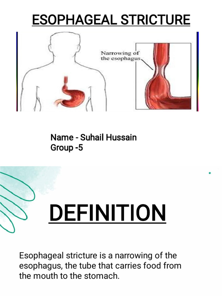 Esophageal Stricture Overview | PDF | Esophagus | Diseases And Disorders