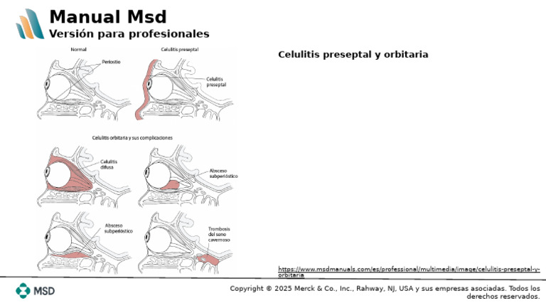 Celulitis Preseptal y Orbitaria | PDF