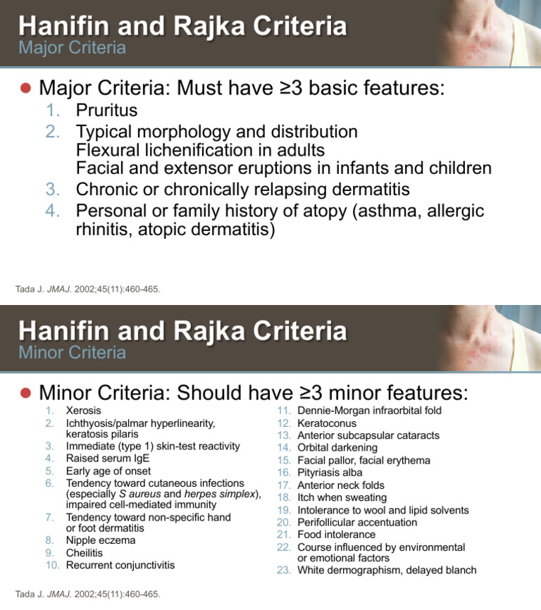 Hanifin and Rajka Criteria | PDF