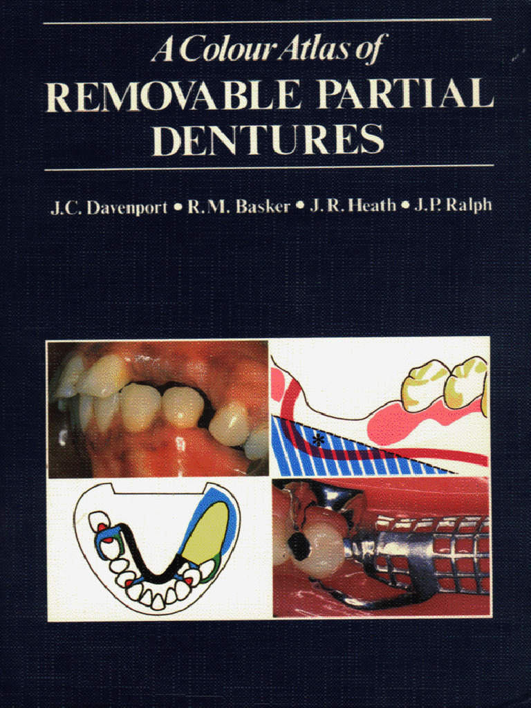 A Colour Atlas of Removable Partial Dentures (PDFDrive) - Compressed | PDF